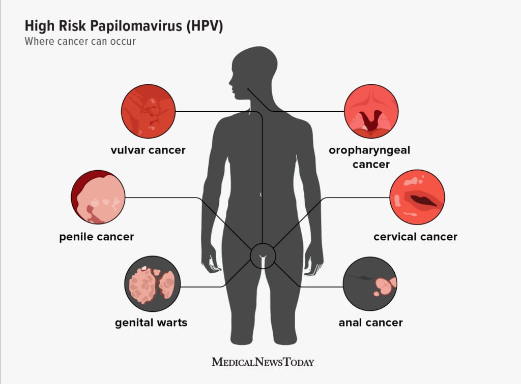 Human Papillomavirus (HPV) Infection: An In-Depth Analysis | Health fitbit