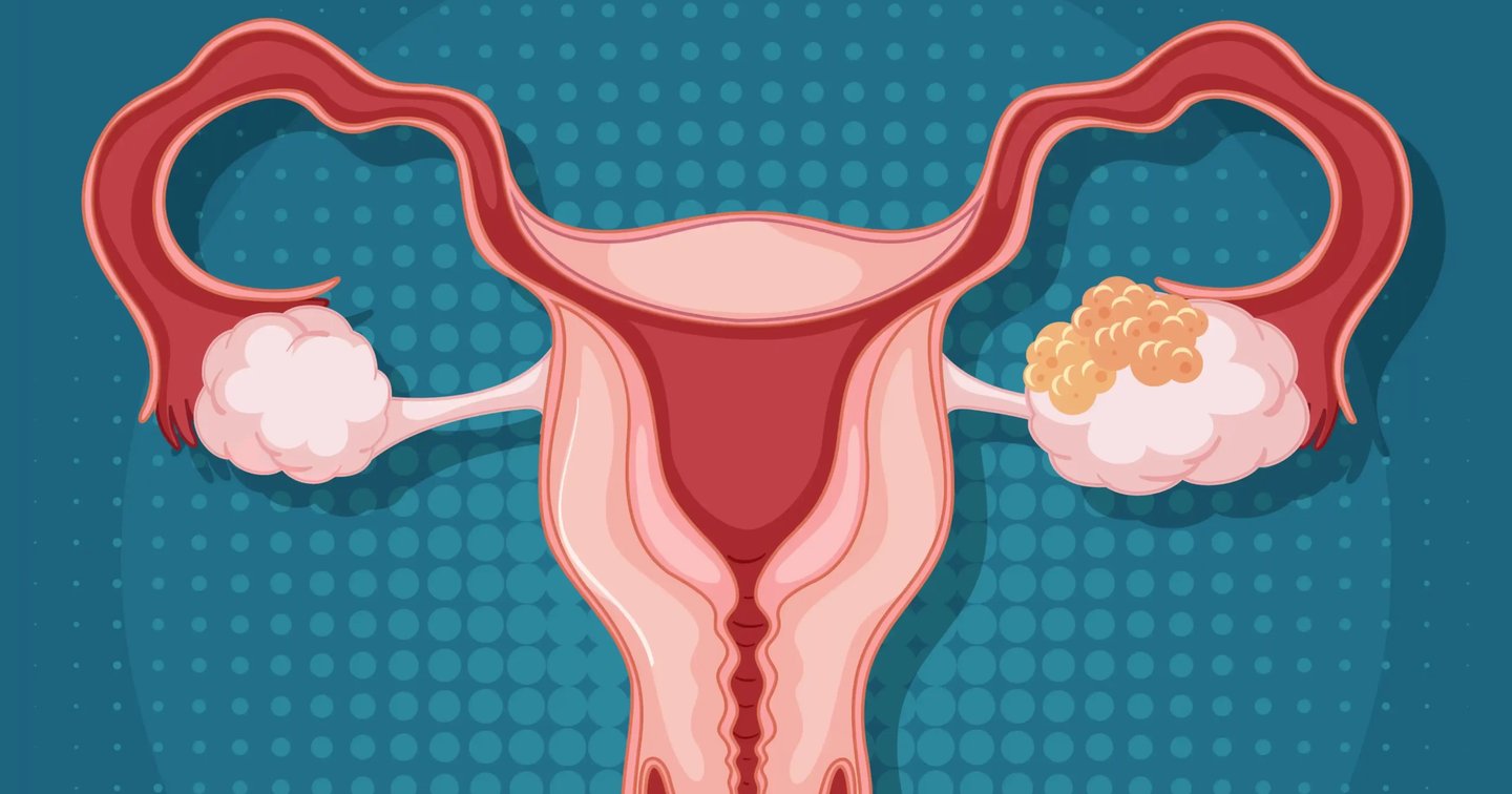 Σύνδρομο Πολυκυστικών Ωοθηκών (PCOS) | Γραββάνης Χρήστος MD, PhD(c ...