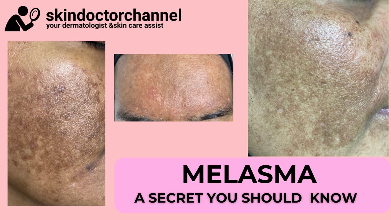Melasma - A secret you need to know before you fight it | Skin Health ...