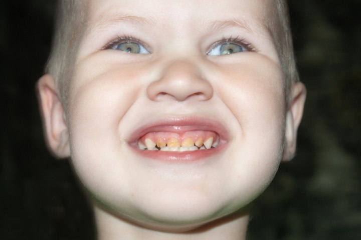 Causes and Prevention of Brown Stains on Your Child's Teeth | SmileWide
