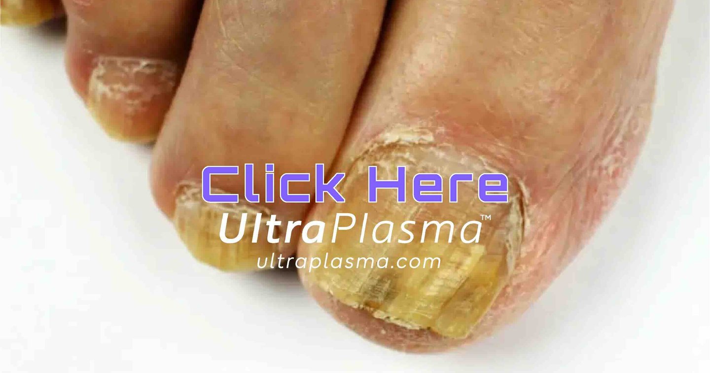 UltraPlasma™ Nail Fungus / Onychomycosis (tinea unguium) Treatment ...