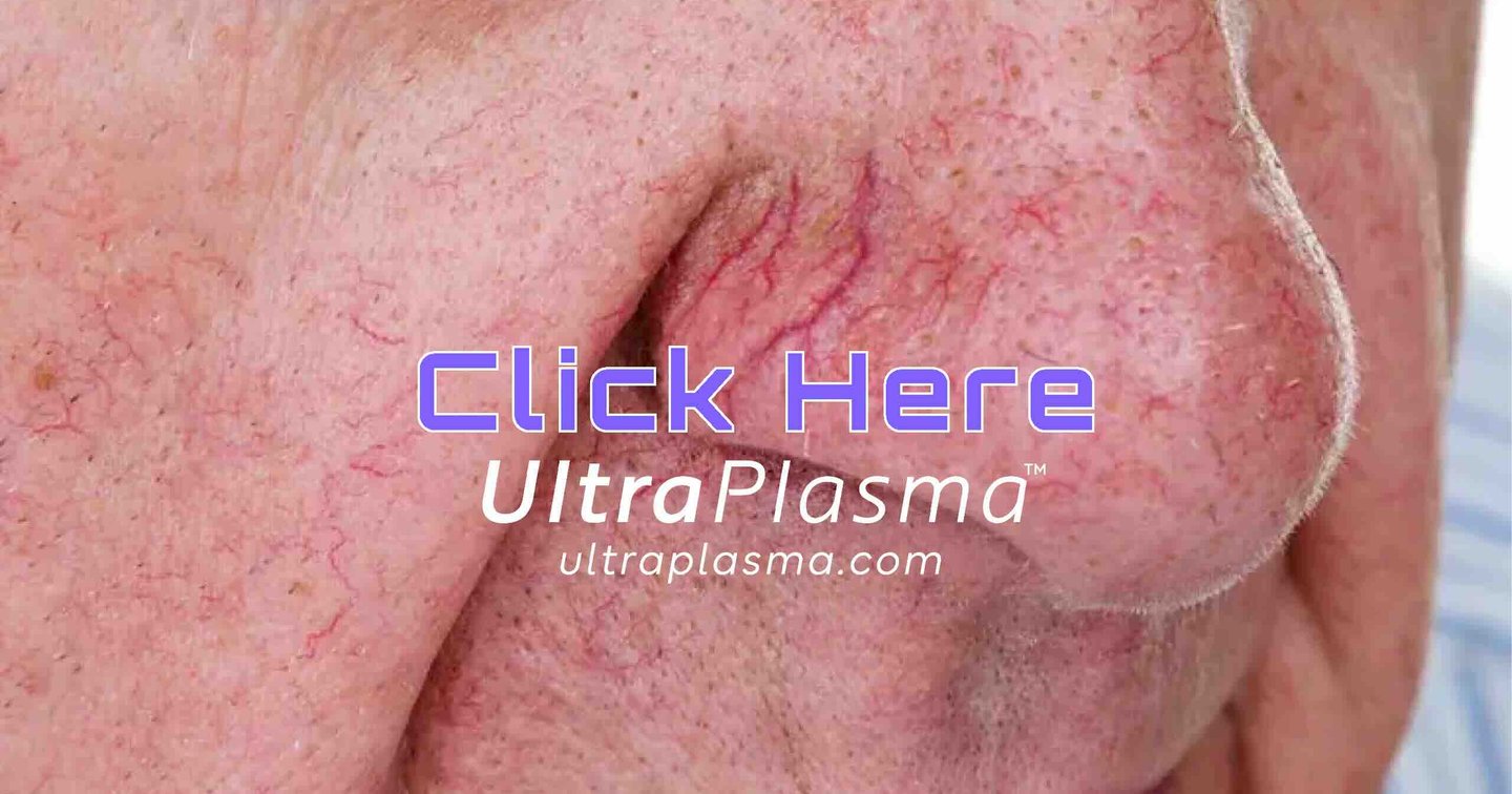 UltraPlasma™ Telangiectasias (Spider Veins) Treatment | UltraPlasma ...