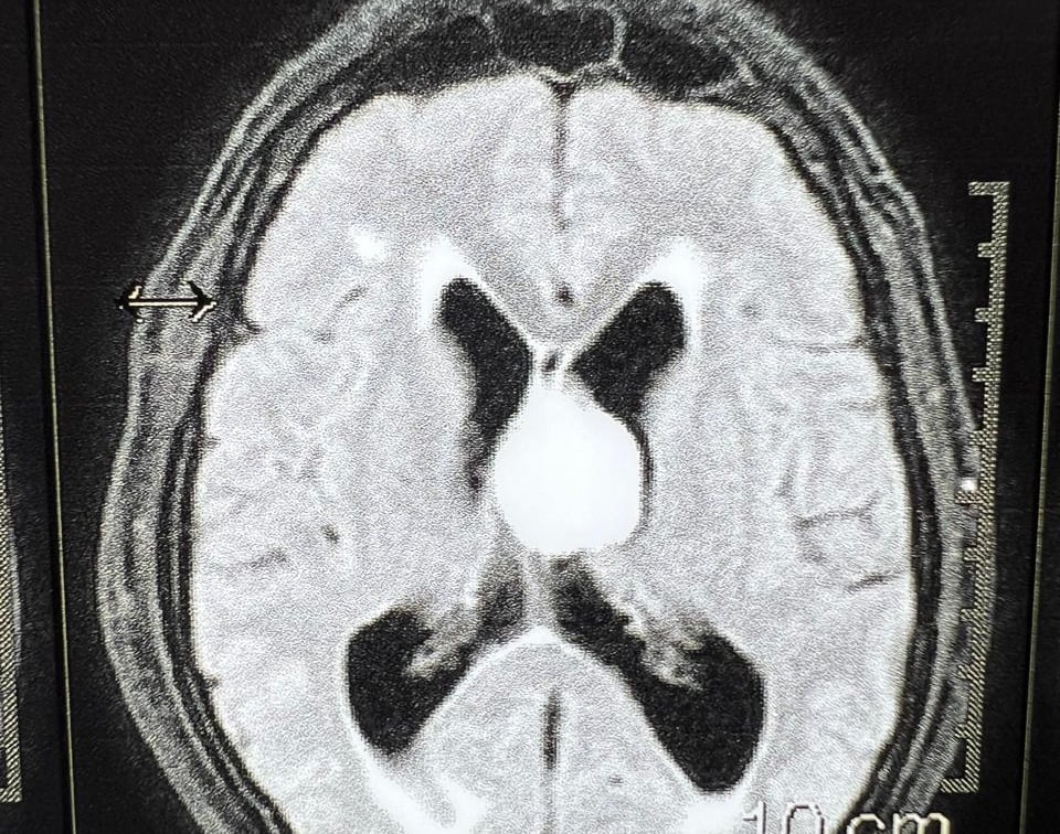 3rd Ventricular Colloid Cyst | Dr Mrudul Bhatjiwale