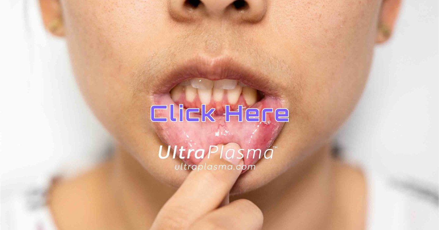 UltraPlasma™ Canker Sore / Aphthous Ulcer Treatment | UltraPlasma ...