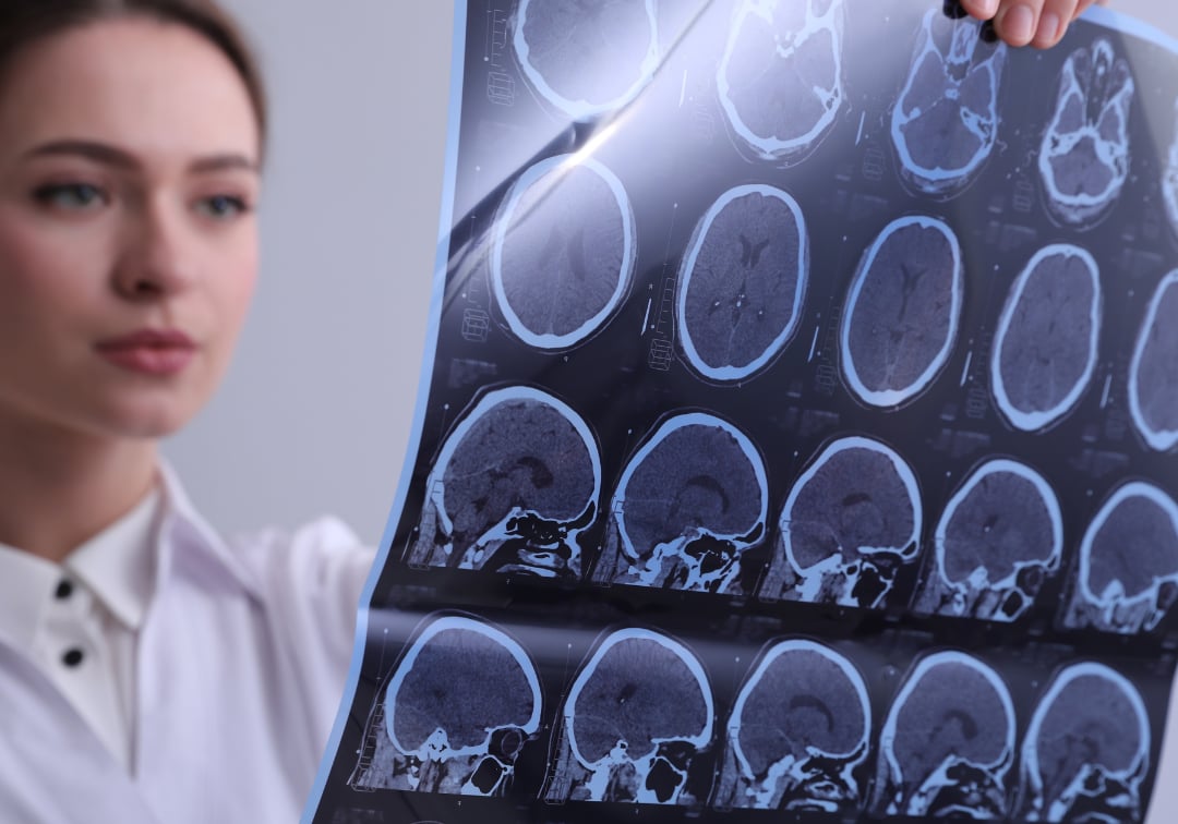 Multiple Sclerosis Explained: From Early Signs to Modern Therapies ...