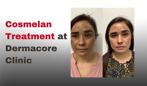 Cosmelan Treatment at Dermacore Clinic | Dermacore