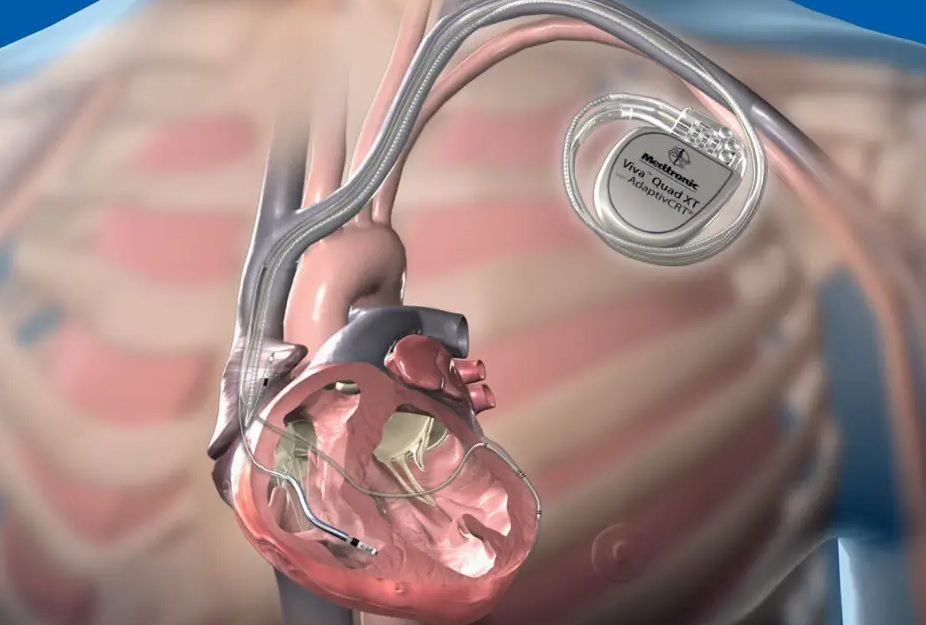 🤖 What is a pacemaker and why do I need one? | Dr Caroli cardiólogo