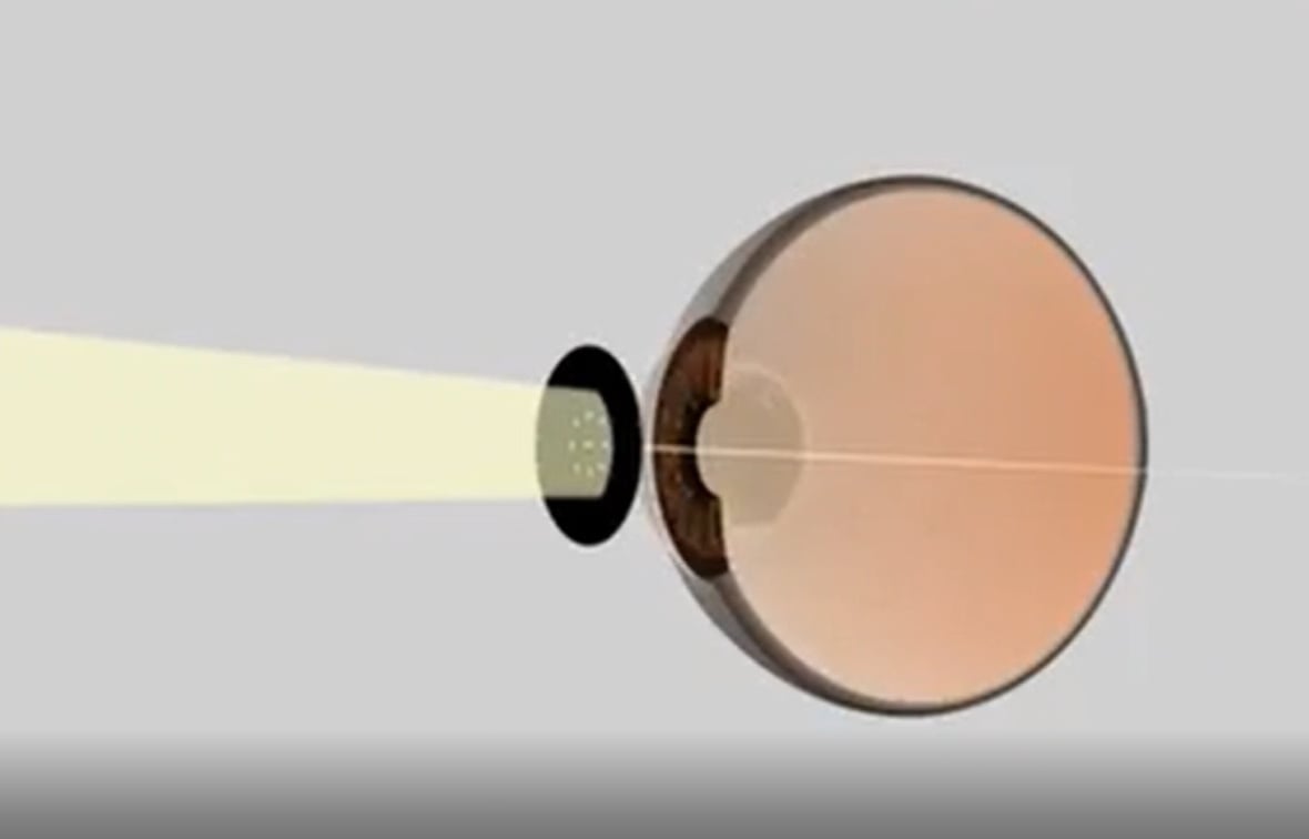 The Power of Pinhole Glasses and Eye Exercises in Improving Your ...