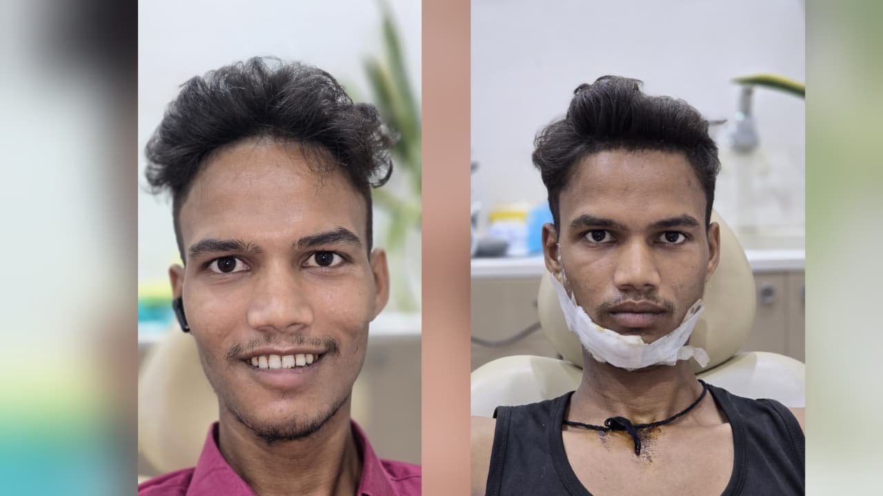 18-Year-Old with Parasymphysis Unilateral Mandibular Fracture Treated ...