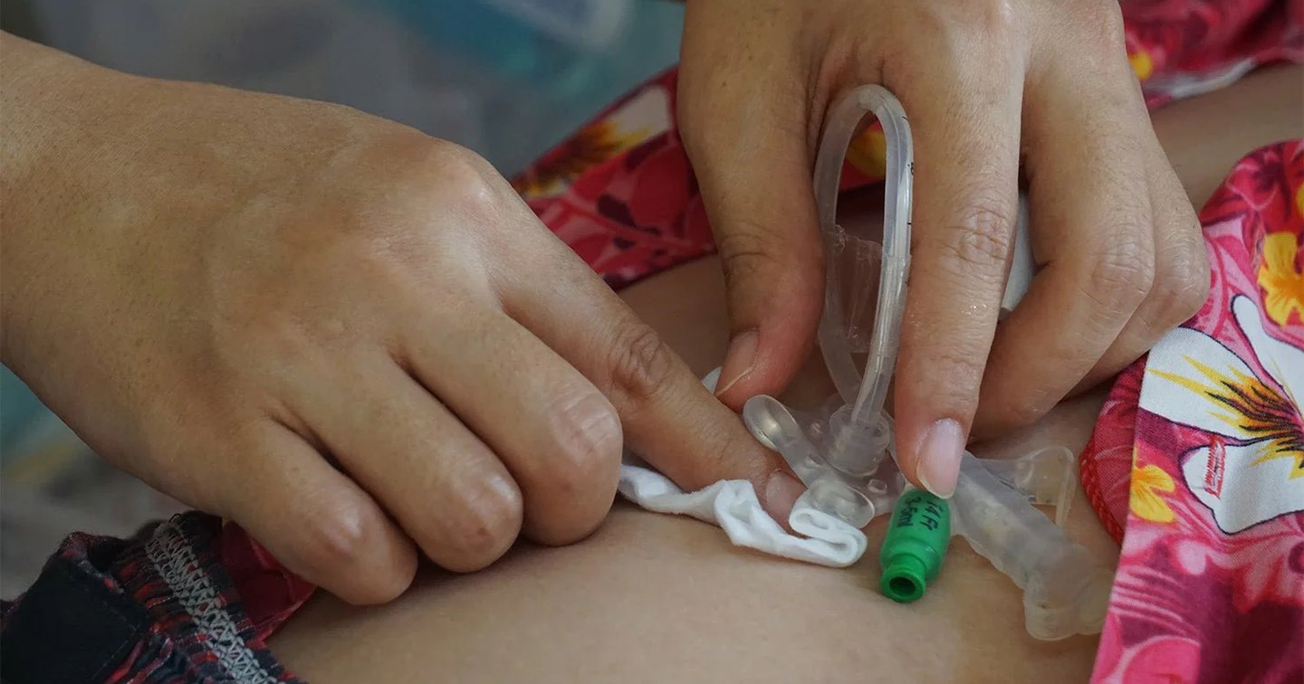 Understanding G-Tubes, J-Tubes, and NG Tubes: Key Differences Explained
