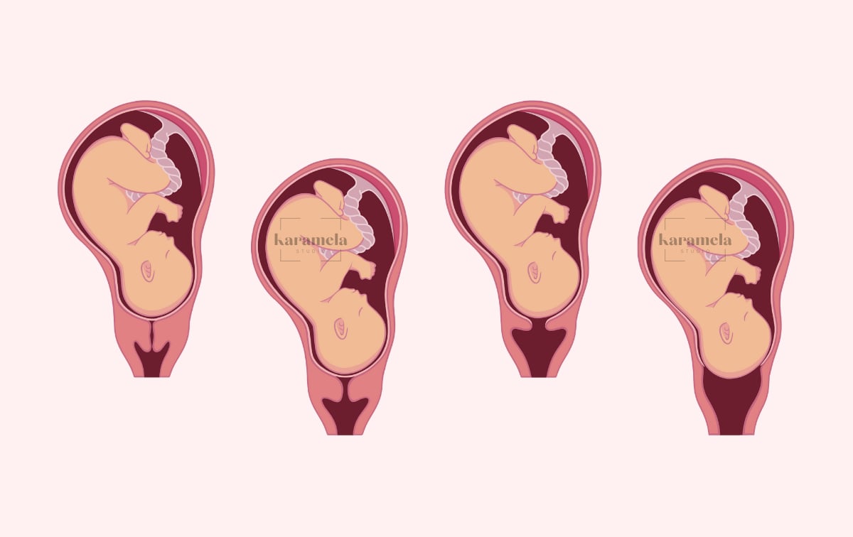 Cervical Dilation and Effacement Explained | Karamela Studio