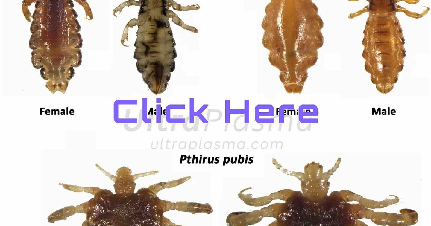 UltraPlasma™ Pediculus Capitis, Corporis, and Phthirus Pubis ...