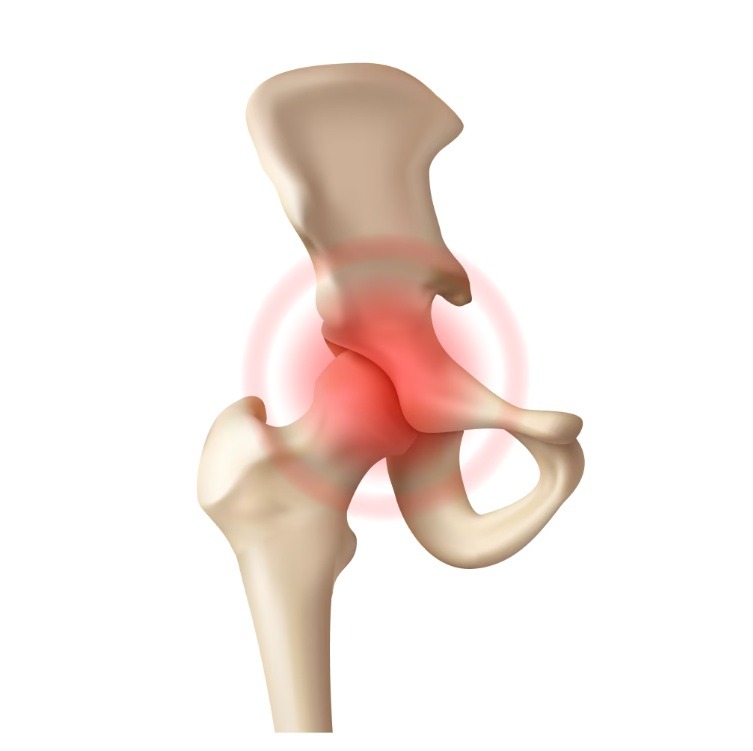 Common and Rare Hip Joint Pathologies