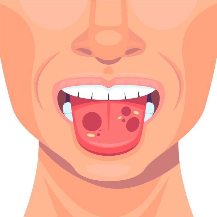 Stomatites : symptômes, causes et traitements pour soigner votre bouche ...