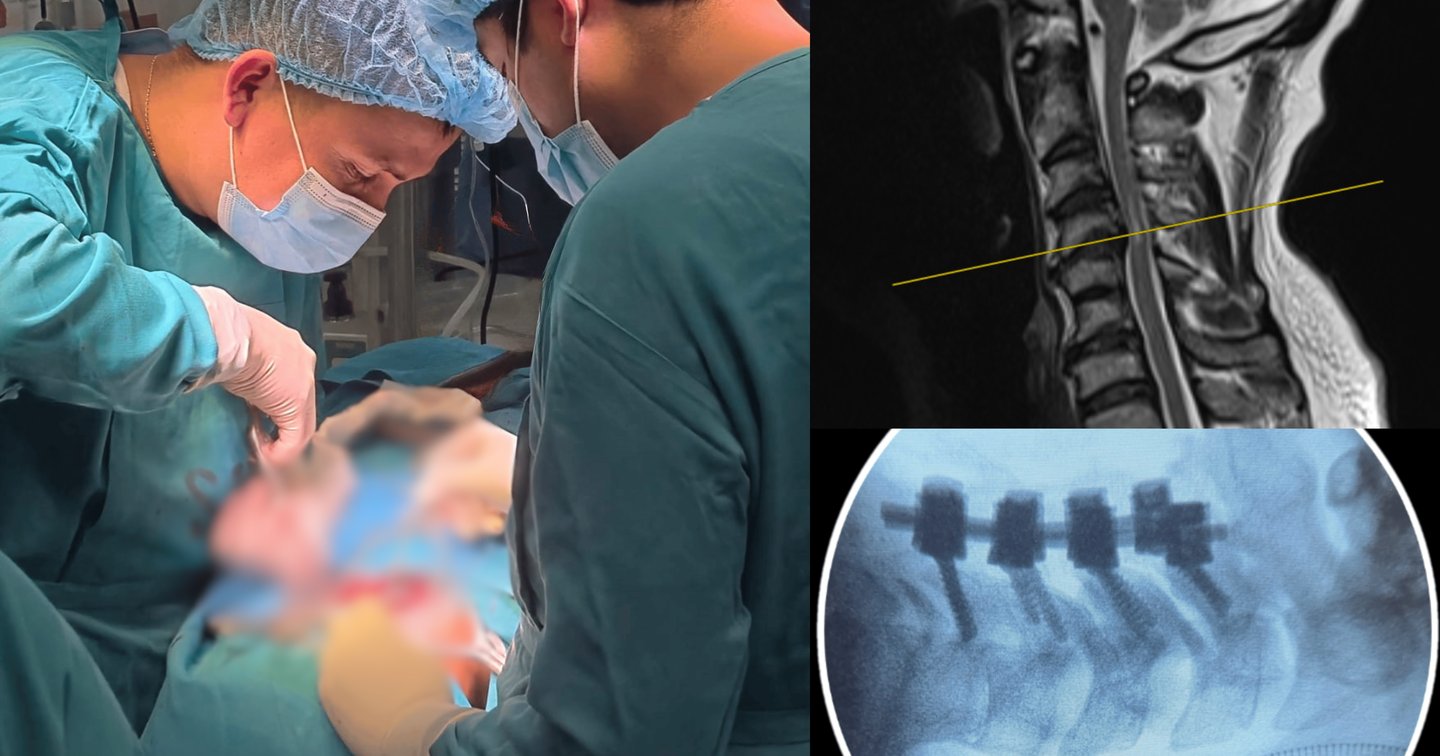 Cirugía de Artrodesis Cervical Posterior con Tornillos a Masa Lateral ...