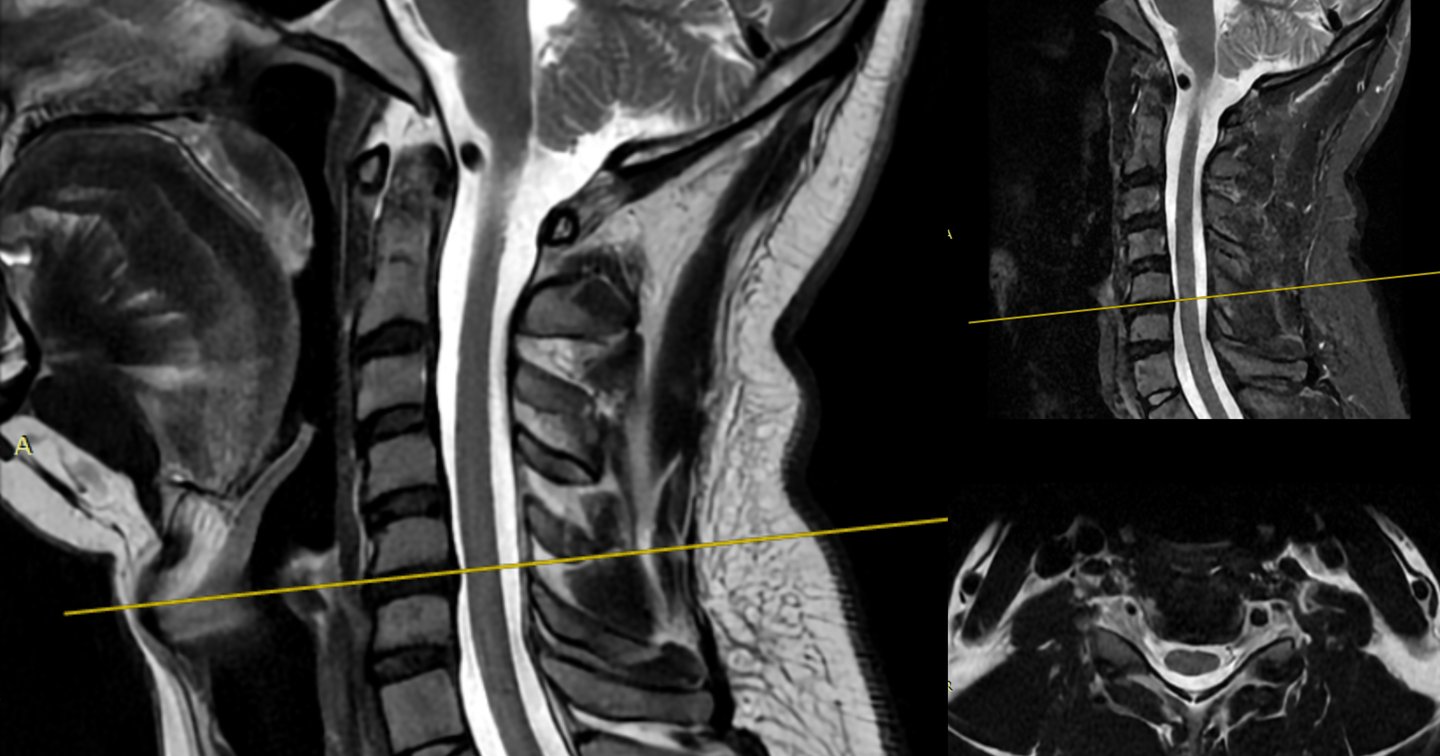 Discopatía Cervical con Inestabilidad de Columna | Diagnóstico por ...