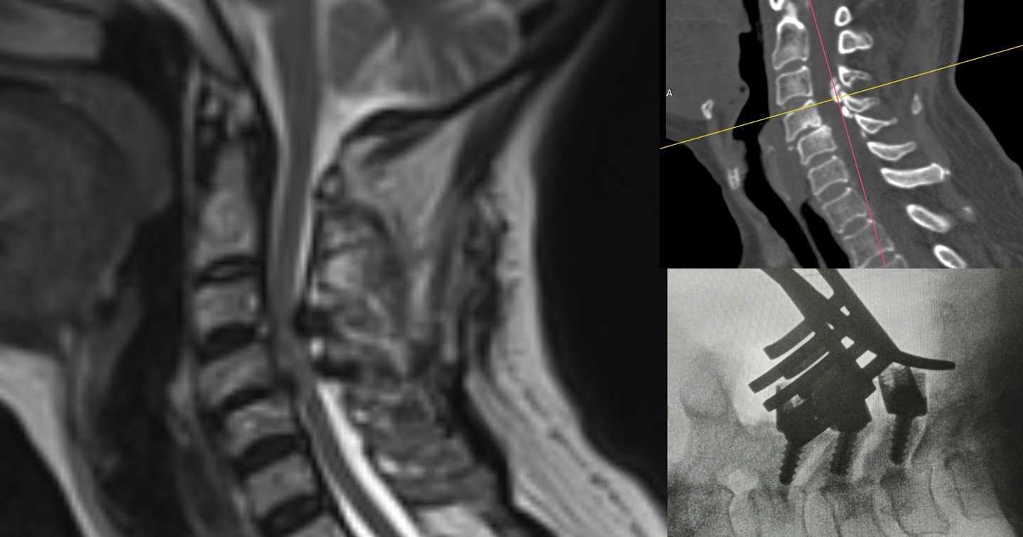 Discopatía y Estenosis Cervical | Cirugía de Artrodesis Cervical ...