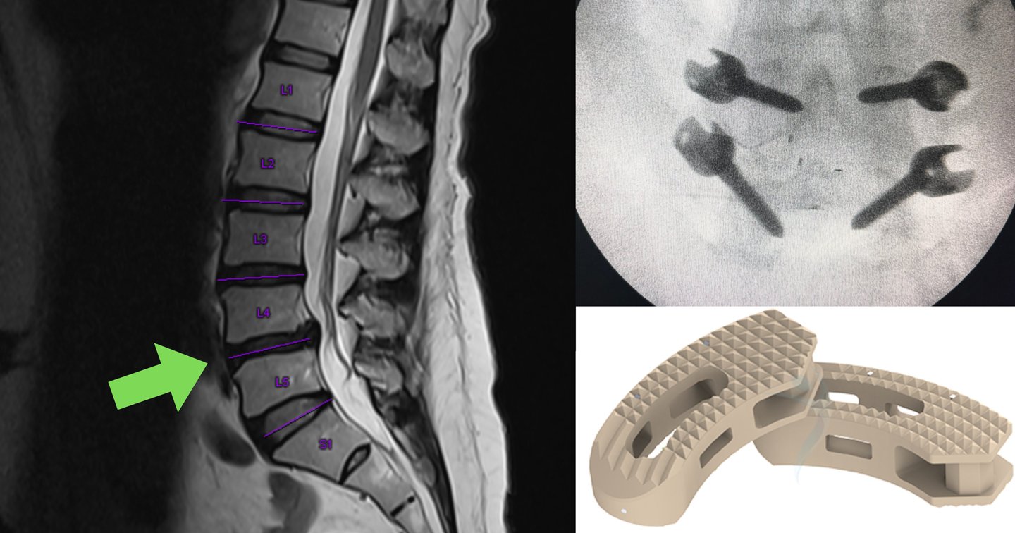Listesis Lumbar: Artrodesis con Tornillos Transpediculares y Fusión ...