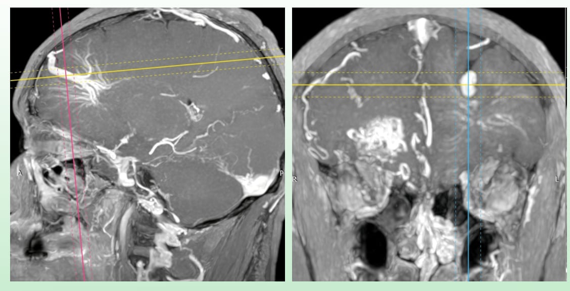 Malformación Arteriovenosa Cerebral (AVM) y Anomalía Venosa del ...