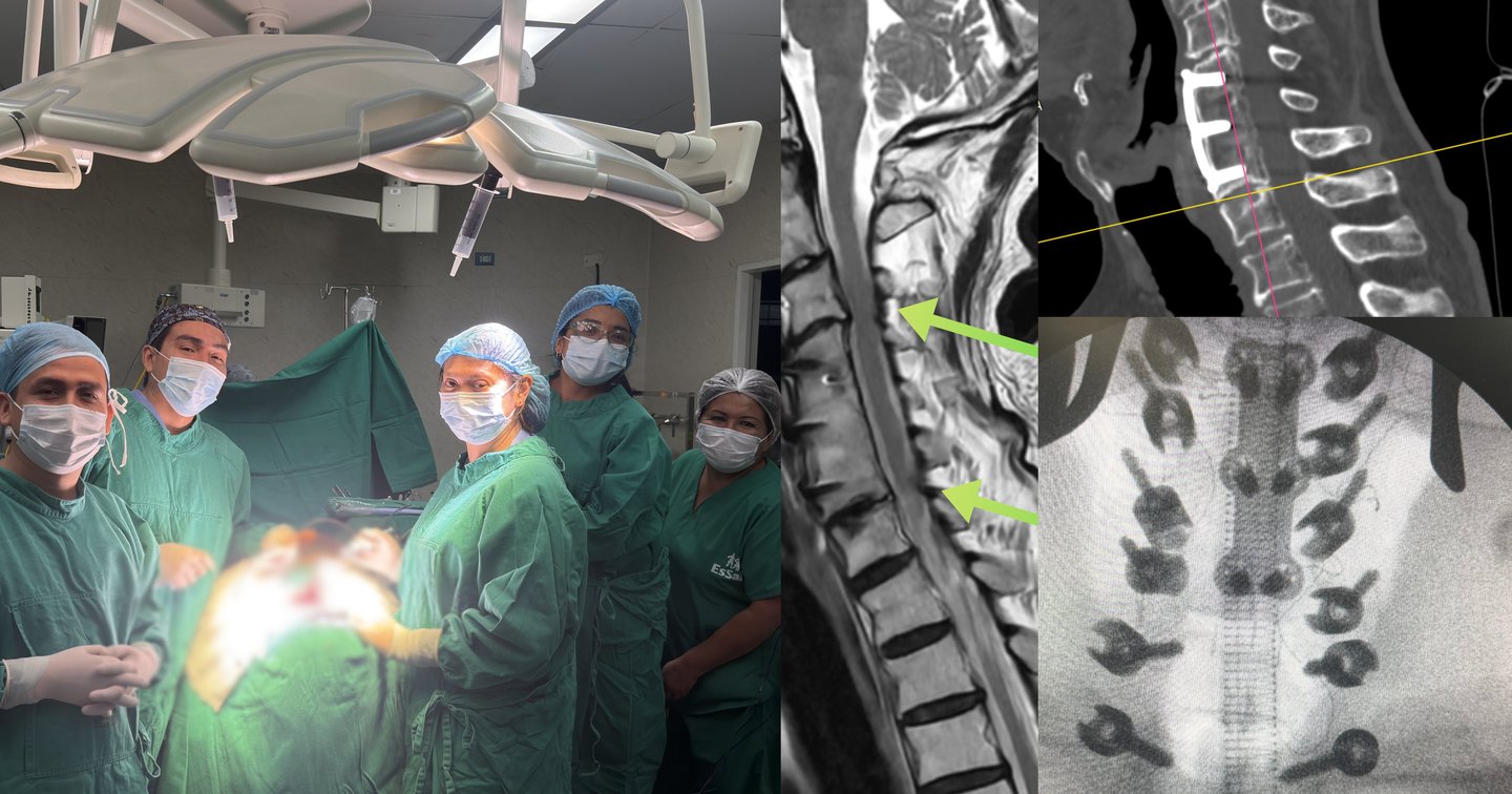 Cirugía de Revisión Cervical: Estabilidad Posterior en Seudoartrosis y ...