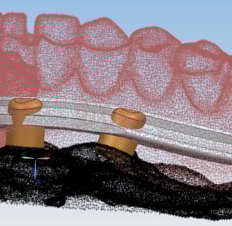 Distal Extensions, Preventing Potential Failures | Memphis Dental ...