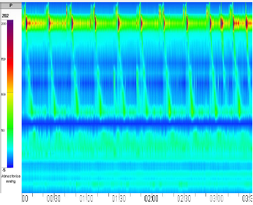 Manometria esofagea | Chirurgia per Tutti
