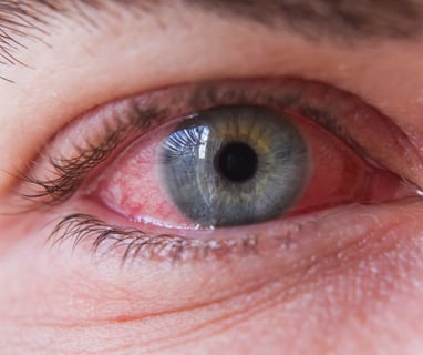 EYEODINE ROLL-ON EYE DROPS - BUY NOW! | eyeodine.org