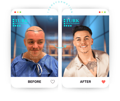 Luxury Hair Transplant Clinic trusted by celebrities | Turk Health Expert | Turk Health Expert
