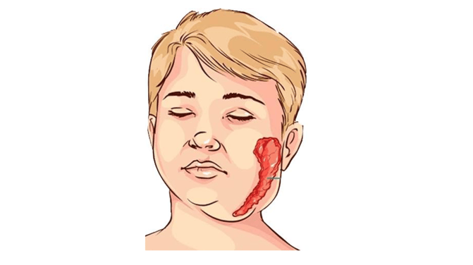 Caxumba: Sintomas, Complicações, Tratamento e Prevenção | Enfermagem de ...