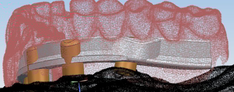 Distal Extensions, Preventing Potential Failures | Memphis Dental ...