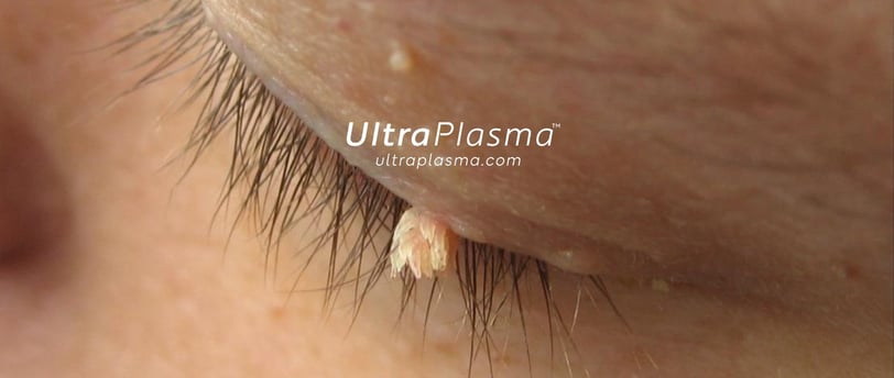 UltraPlasma™ Wart (Verruca Vulgaris) Treatment | UltraPlasma™ Human ...