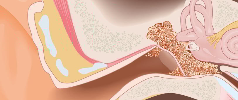 Colesteatoma: Tudo que você precisa saber sobre esse tumor no ouvido ...