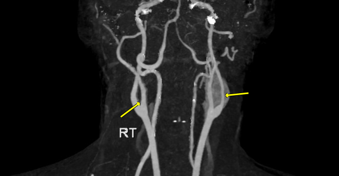Understanding Carotid Body Tumors | Jordan Vascular Clinic