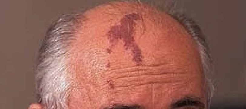 UltraPlasma™ Port-Wine Stain (Nevus Flammeus) Treatment | UltraPlasma ...