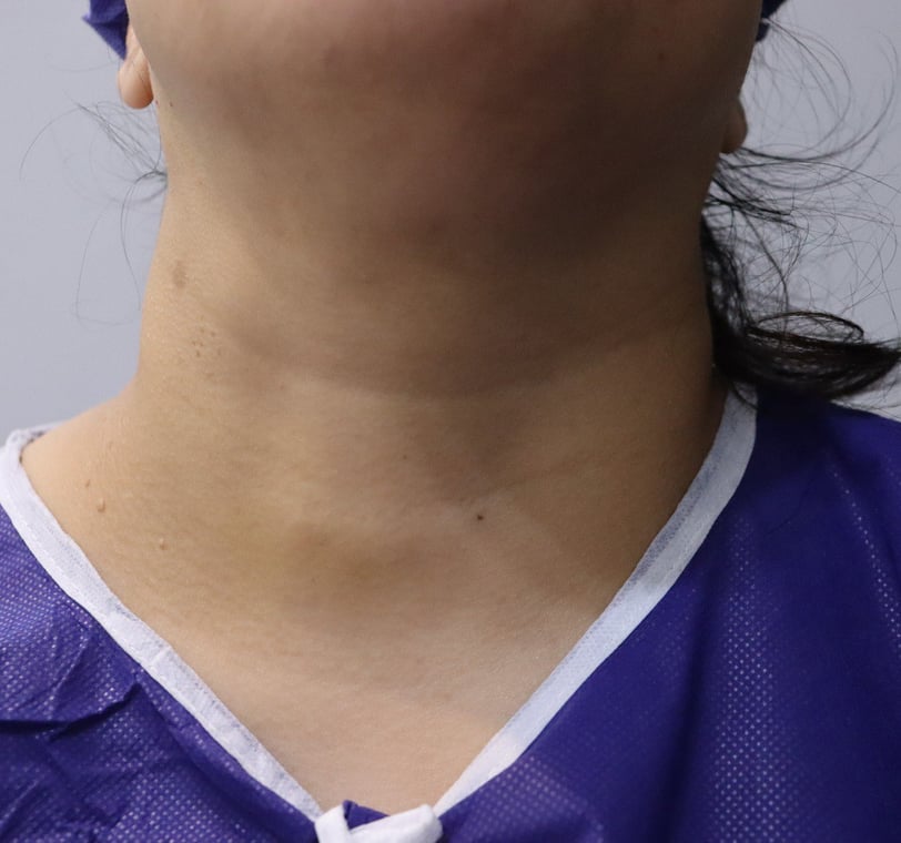 Cystic Nodule with Multinodular Goiter and Branchial Cleft Cyst | SST
